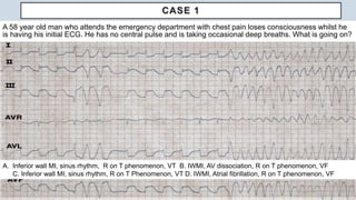 INTERESTING ECGS -- PART II | PPTX