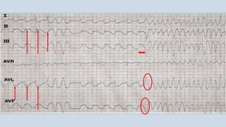 INTERESTING ECGS -- PART II | PPTX