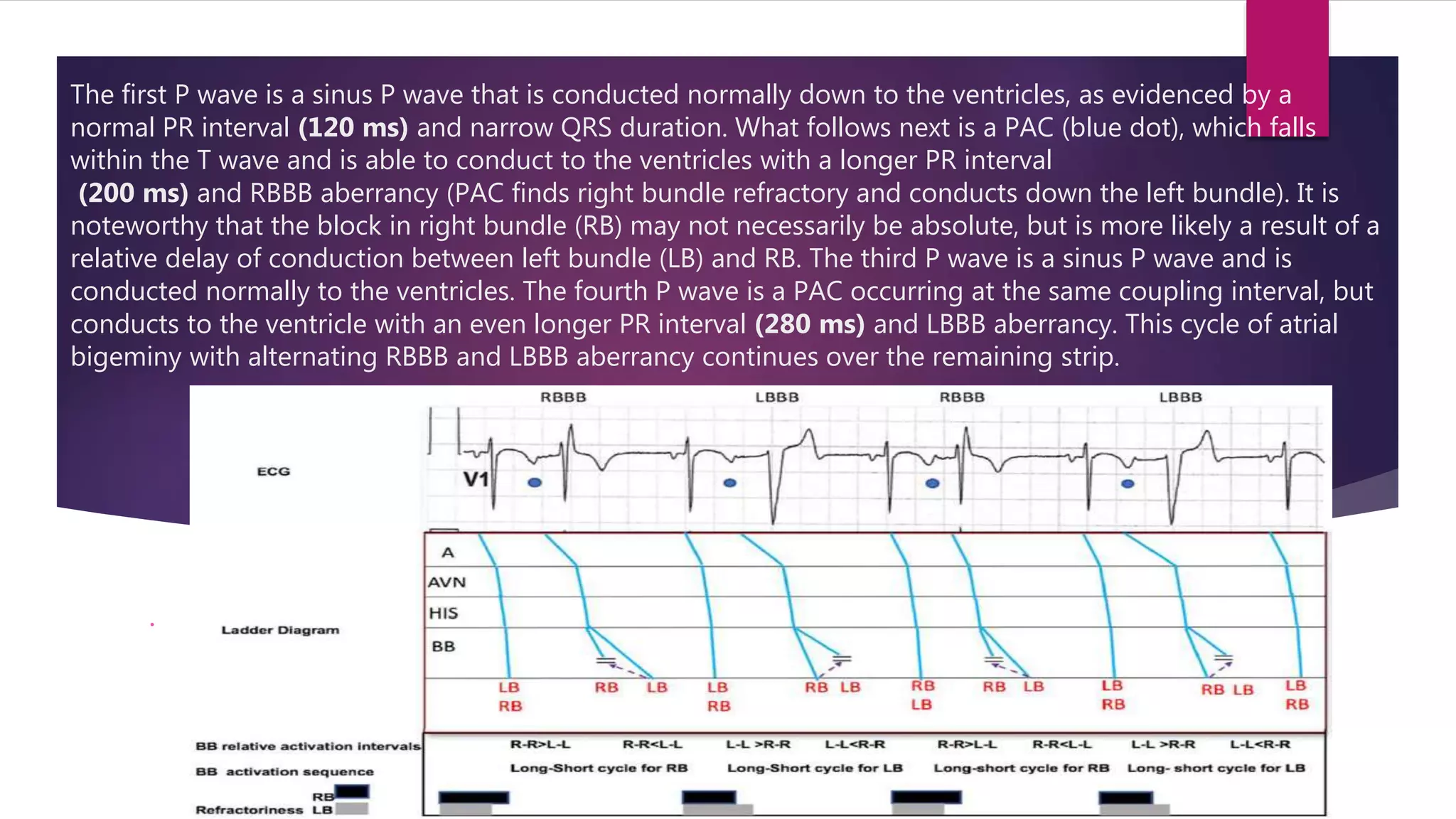 Interesting ecg tracing 1 Alternating Bundle Branch Block | PPTX