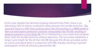 Interesting ecg tracing 1 Alternating Bundle Branch Block | PPTX