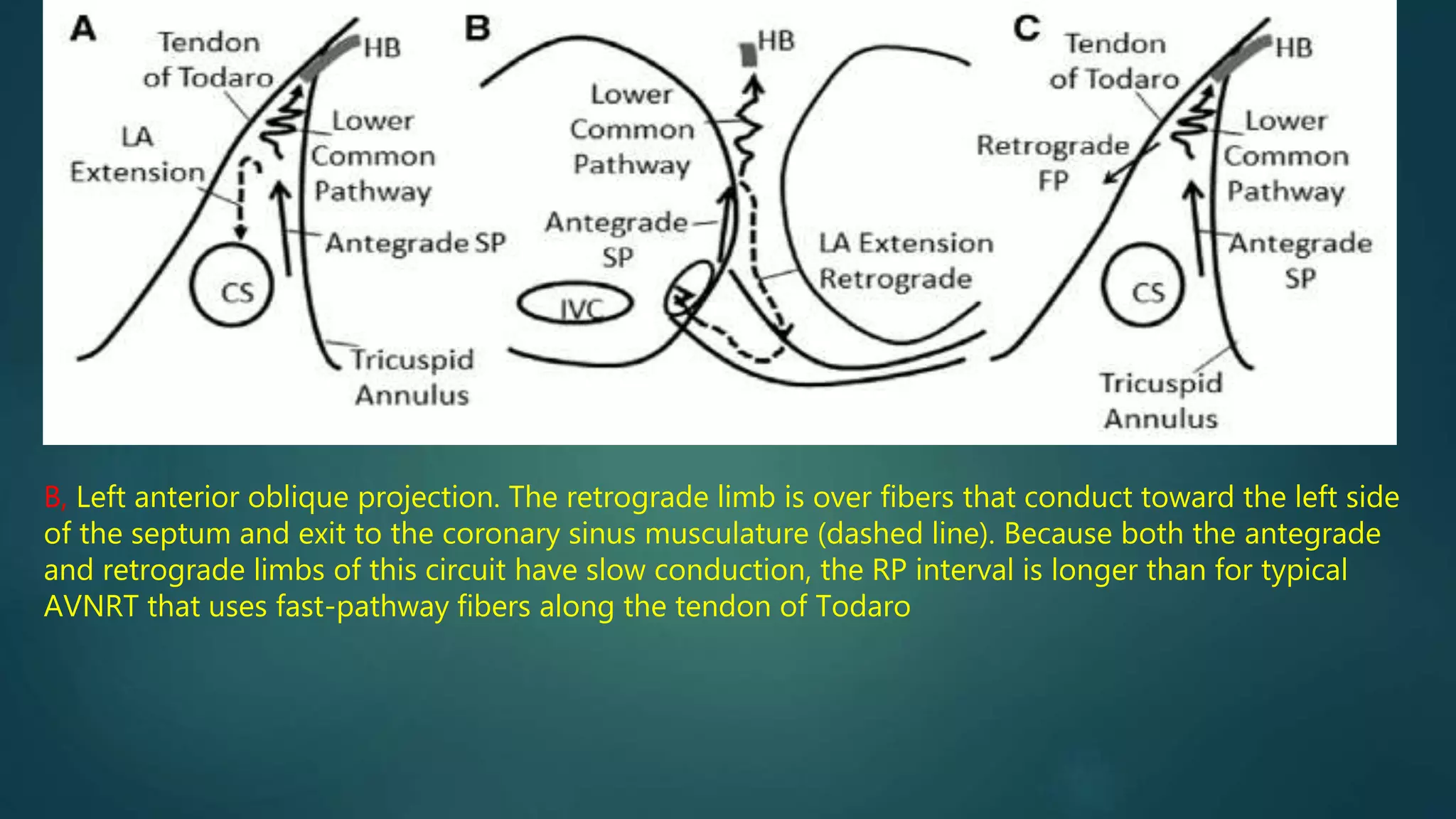 Interesting ecg tracing 2 SVT mechanism | PPTX