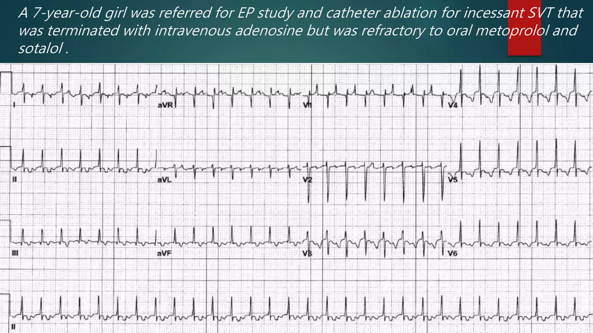 Interesting ecg tracing 2 SVT mechanism | PPTX