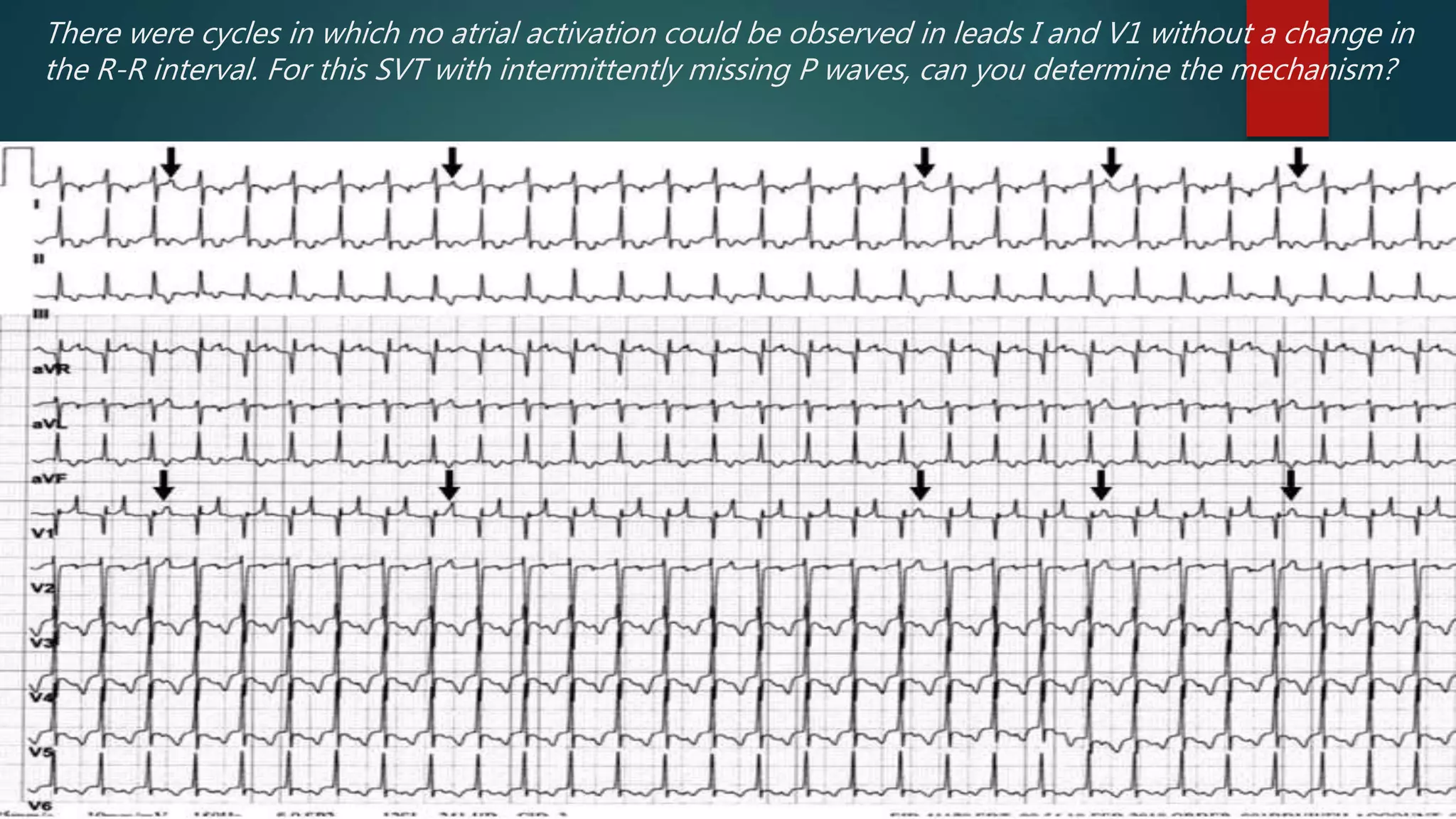 Interesting ecg tracing 2 SVT mechanism | PPTX | Heart and ...
