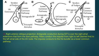 Interesting ecg tracing 2 SVT mechanism | PPTX | Heart and ...