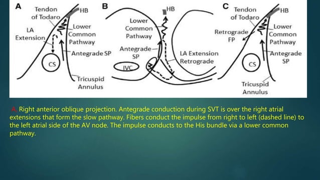 Interesting ecg tracing 2 SVT mechanism | PPT