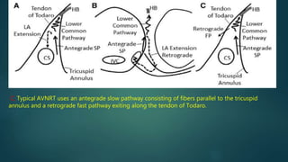 Interesting ecg tracing 2 SVT mechanism | PPTX | Heart and ...