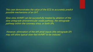 Interesting ecg tracing 2 SVT mechanism | PPTX | Heart and ...