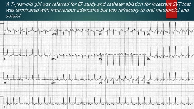 Interesting ecg tracing 2 SVT mechanism | PPT