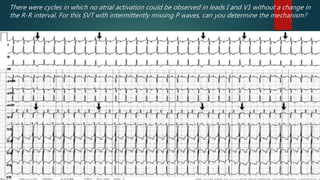 Interesting ecg tracing 2 SVT mechanism | PPTX | Heart and ...
