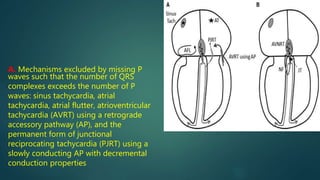 Interesting ecg tracing 2 SVT mechanism | PPTX | Heart and ...