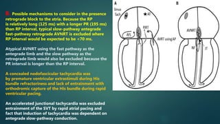 Interesting ecg tracing 2 SVT mechanism | PPTX | Heart and ...