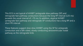 Interesting ecg tracing 2 SVT mechanism | PPTX | Heart and ...