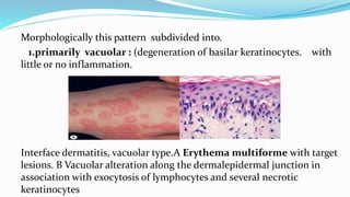interface dermatitis.pptx