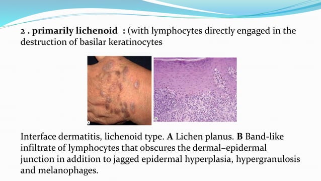 interface dermatitis.pptx