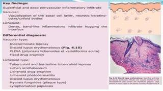 interface dermatitis.pptx