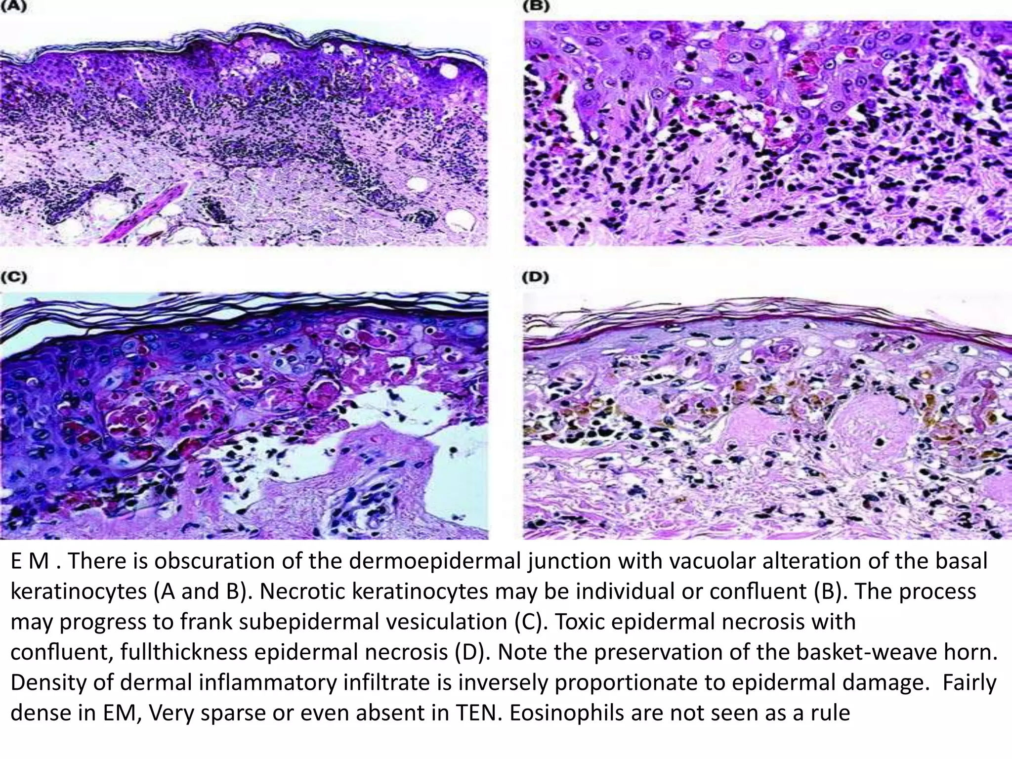 Interface dermatitis tutorial | PPTX