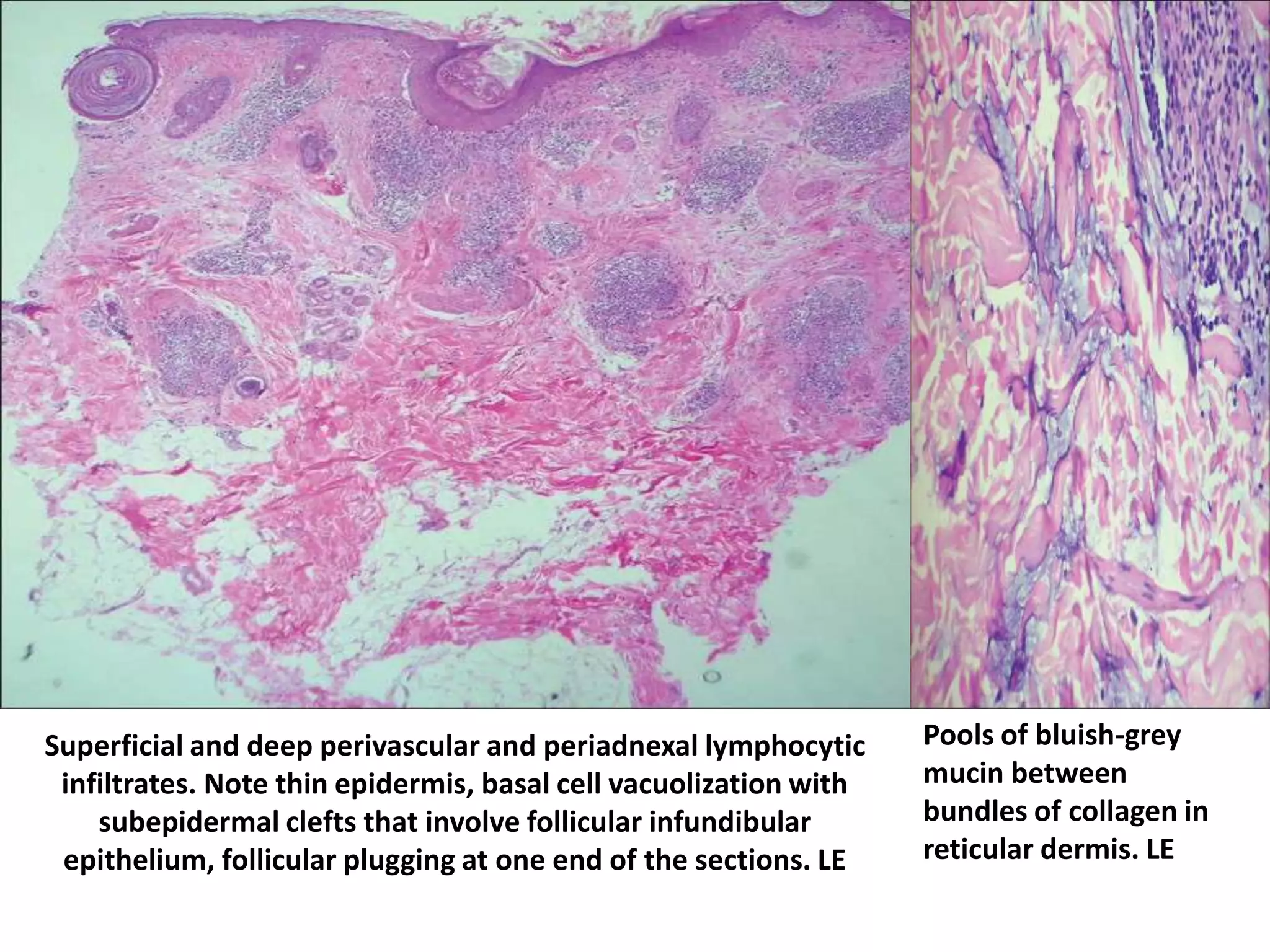Interface dermatitis tutorial | PPTX