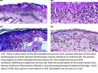 Interface dermatitis tutorial | PPTX