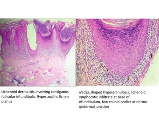 Interface dermatitis tutorial | PPTX