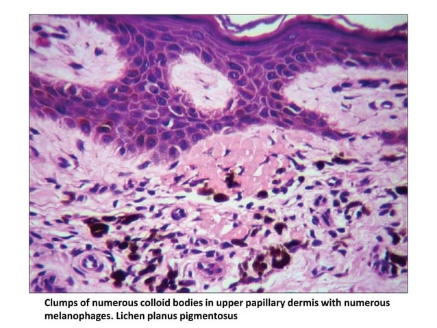 Interface dermatitis tutorial | PPTX | Skin and Dermatology | Diseases ...