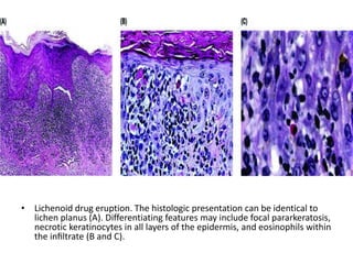 Interface dermatitis tutorial | PPTX