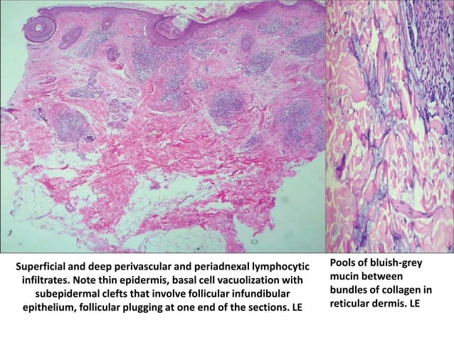 Interface dermatitis tutorial | PPTX | Skin and Dermatology | Diseases ...