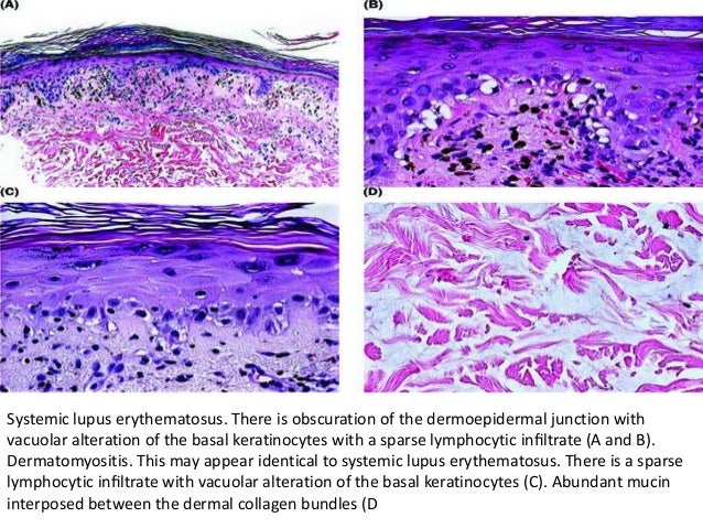 Interface dermatitis tutorial
