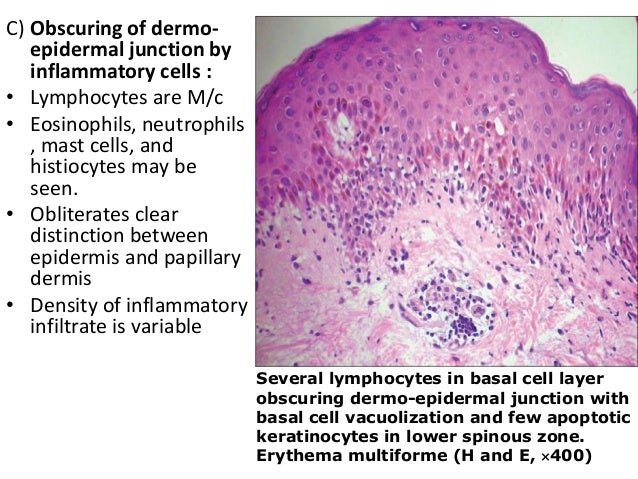 Interface dermatitis tutorial