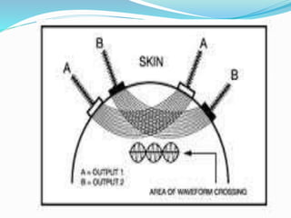 Interferential current | PPTX