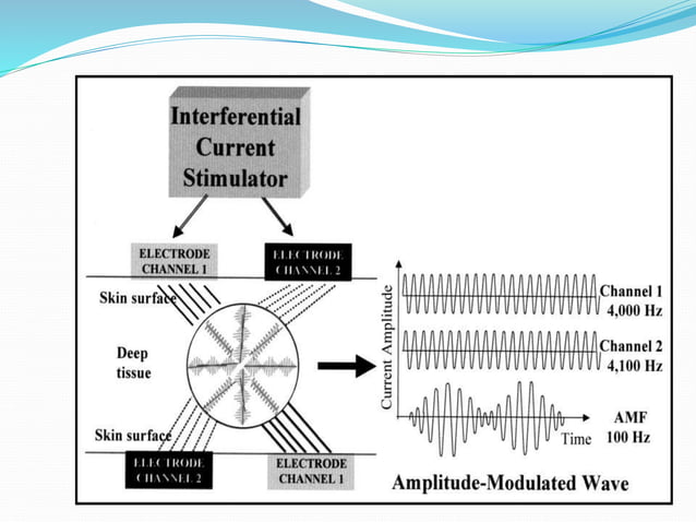 Interferential current | PPT