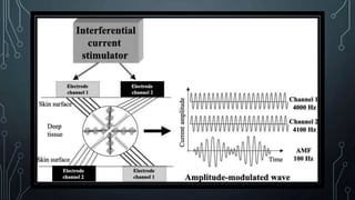 Interferential current (ifc) | PPTX