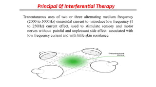 interfernatial_therapy part 2 electro.ppt