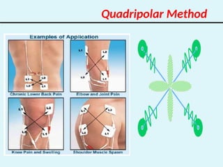 interfernatialtherapy electromodality.ppt