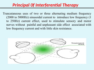 interfernatialtherapy electromodality.ppt