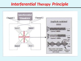 interfernatialtherapy electromodality.ppt