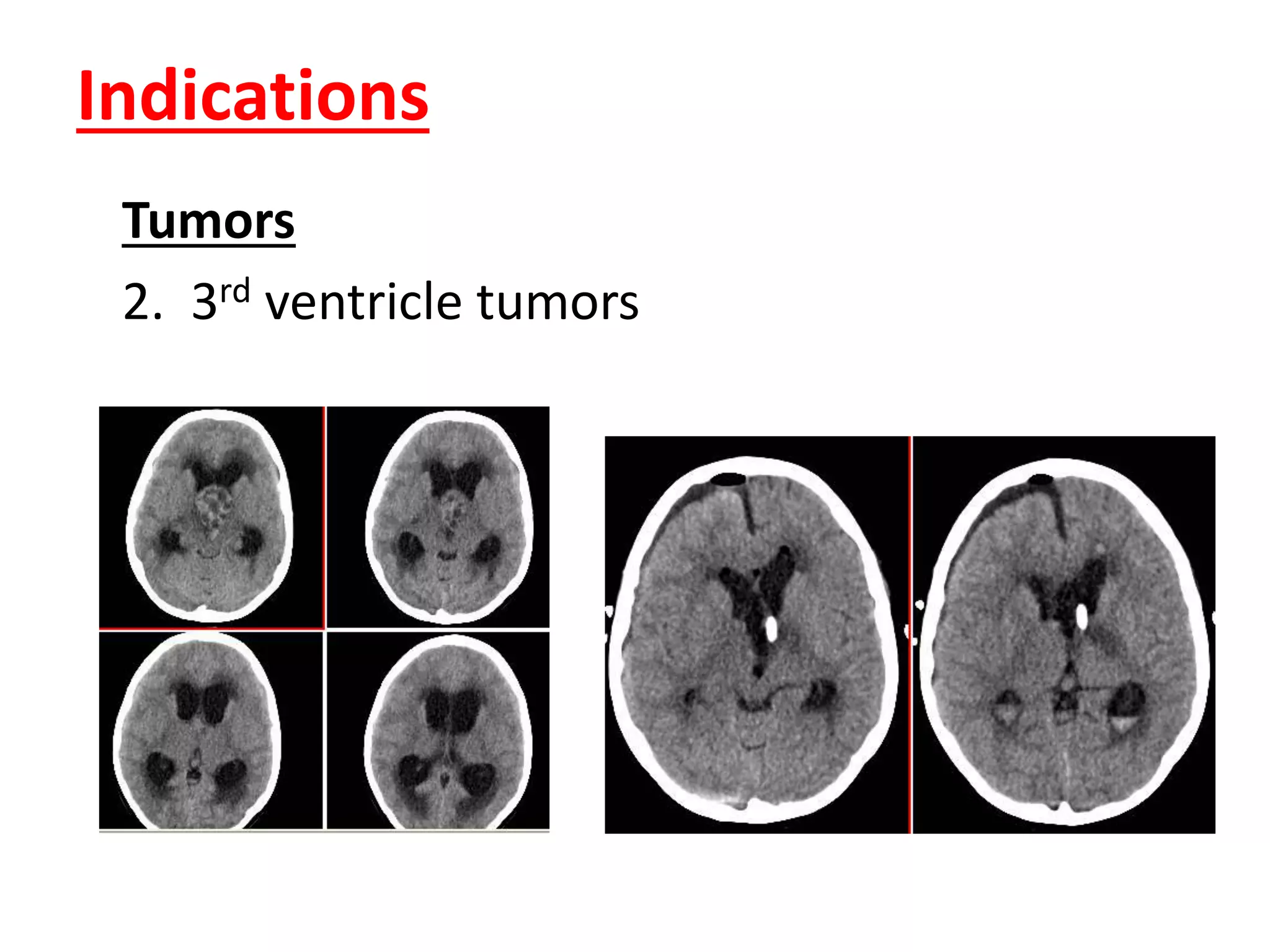 Surgical approach for tumors in the lateral and third ventricle | PPTX