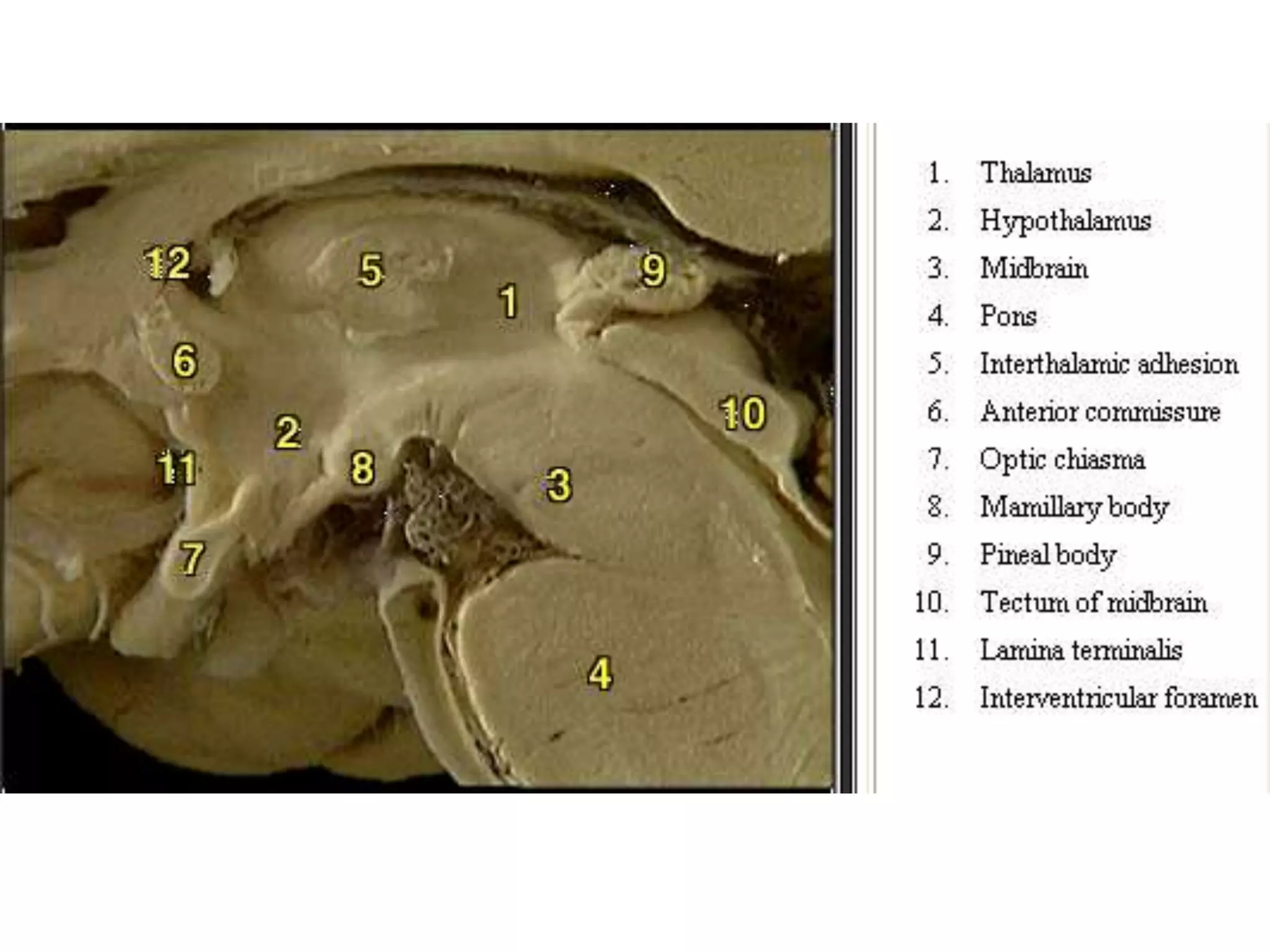 Surgical approach for tumors in the lateral and third ventricle | PPTX