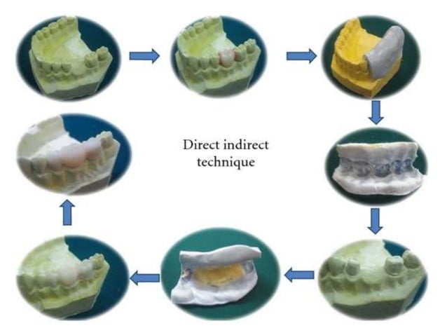 Interim fixed restorations | PPTX