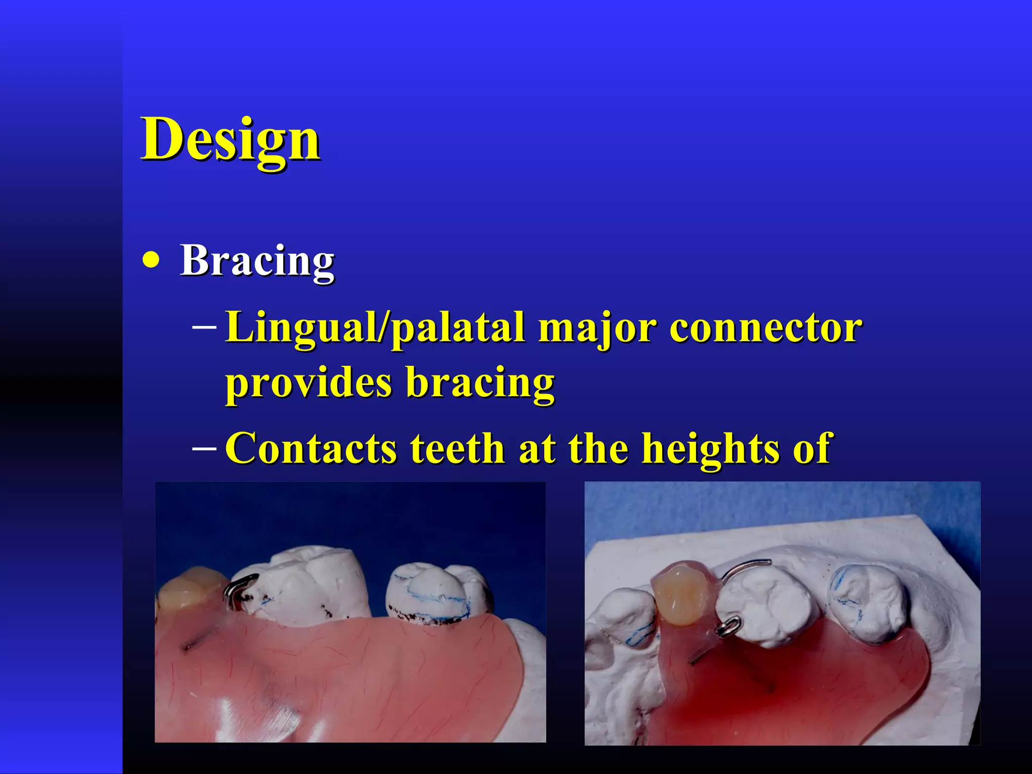 interim removable partial dentures | PPT