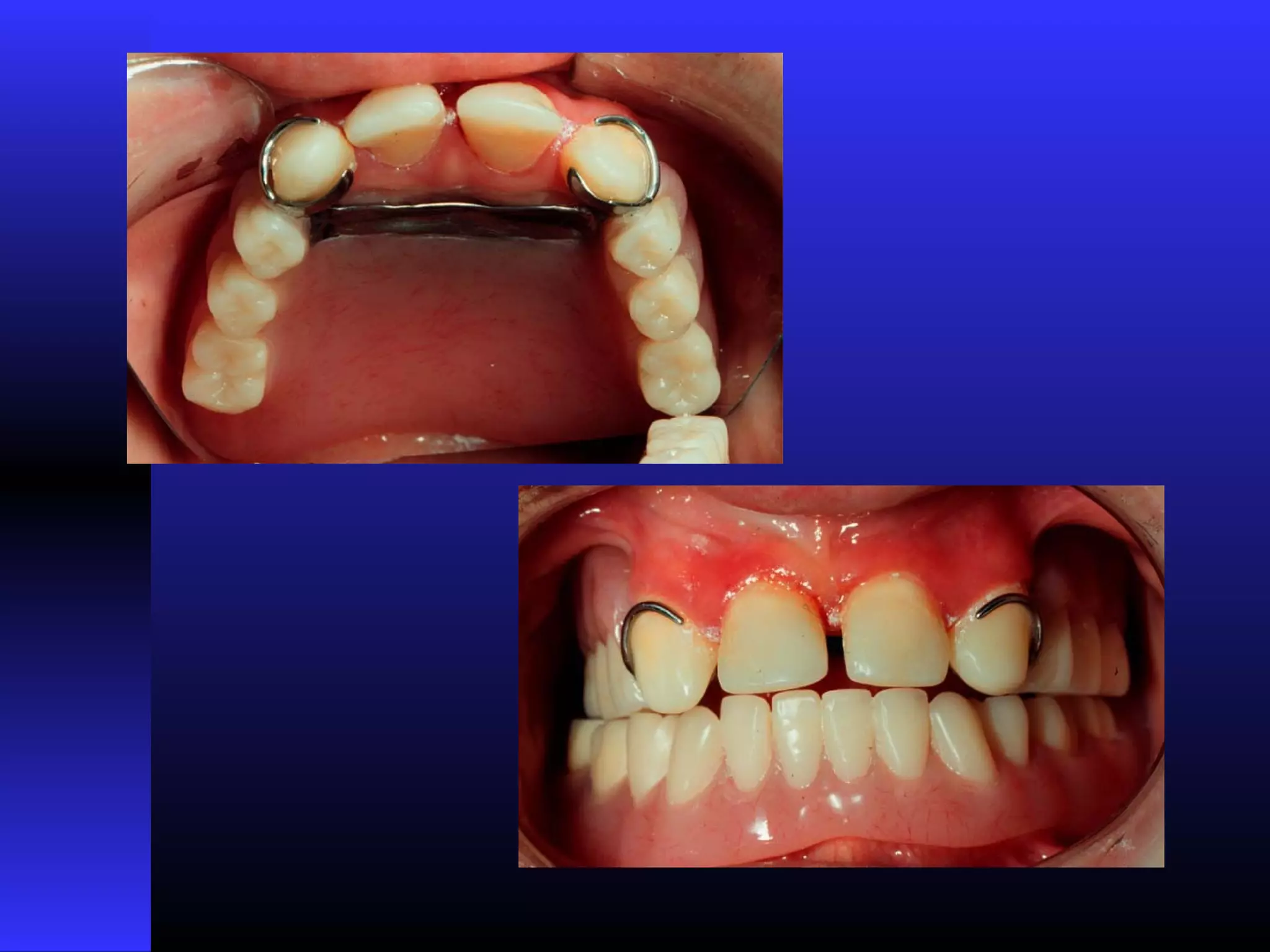 interim removable partial dentures | PPT