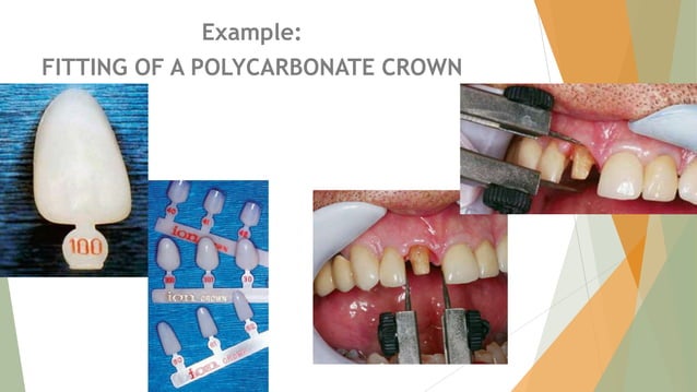 Interim Fixed Restorations.pptx