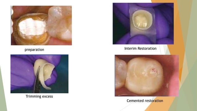 Interim Fixed Restorations.pptx