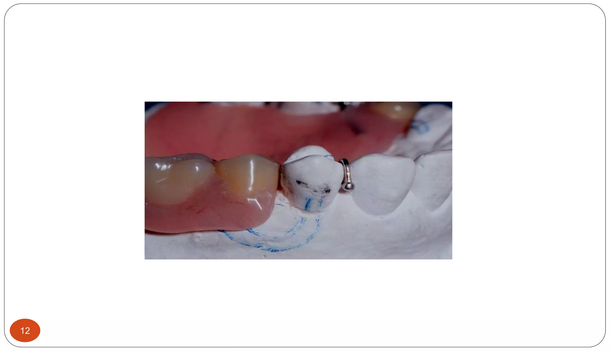 Interim removable partial dentures | PPTX