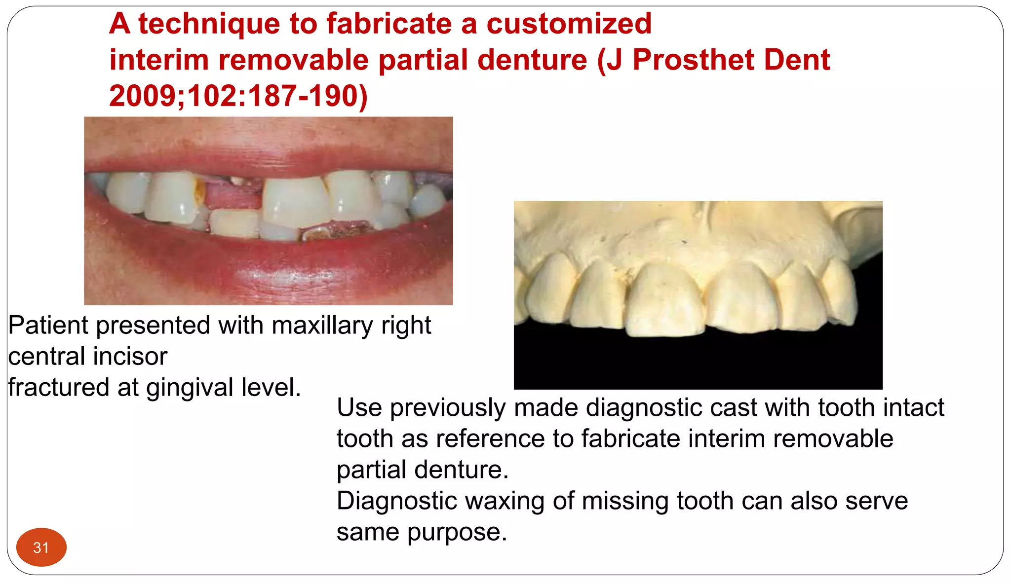Interim removable partial dentures | PPTX