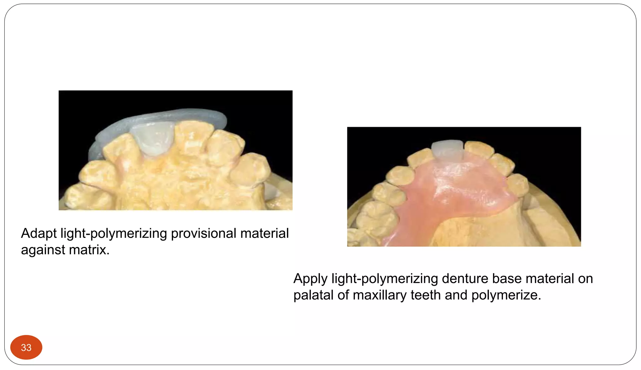 Interim removable partial dentures | PPTX | Oral care | Personal Care