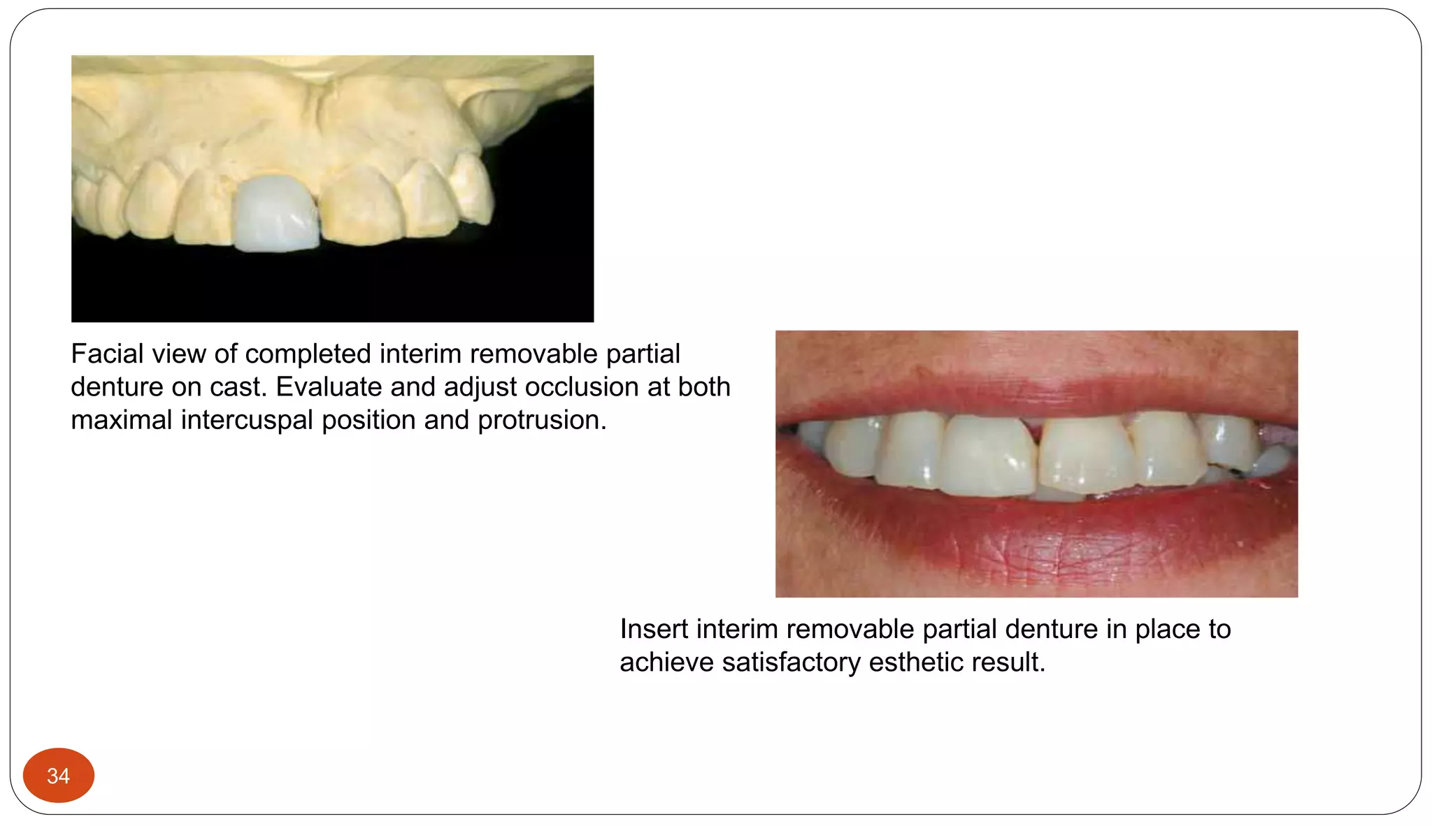 Interim removable partial dentures | PPTX