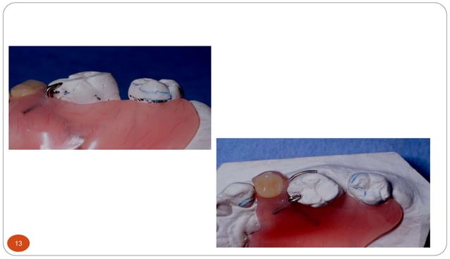 Interim removable partial dentures | PPTX | Oral care | Personal Care