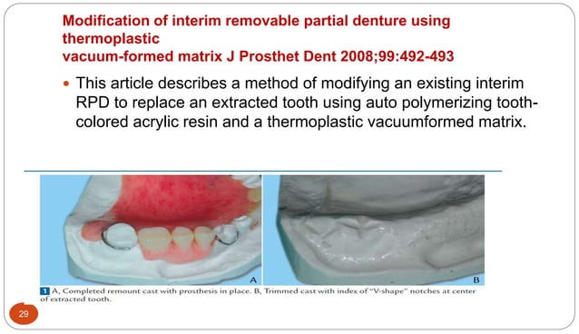 Interim removable partial dentures | PPTX | Oral care | Personal Care