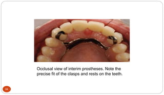 Interim removable partial dentures | PPT