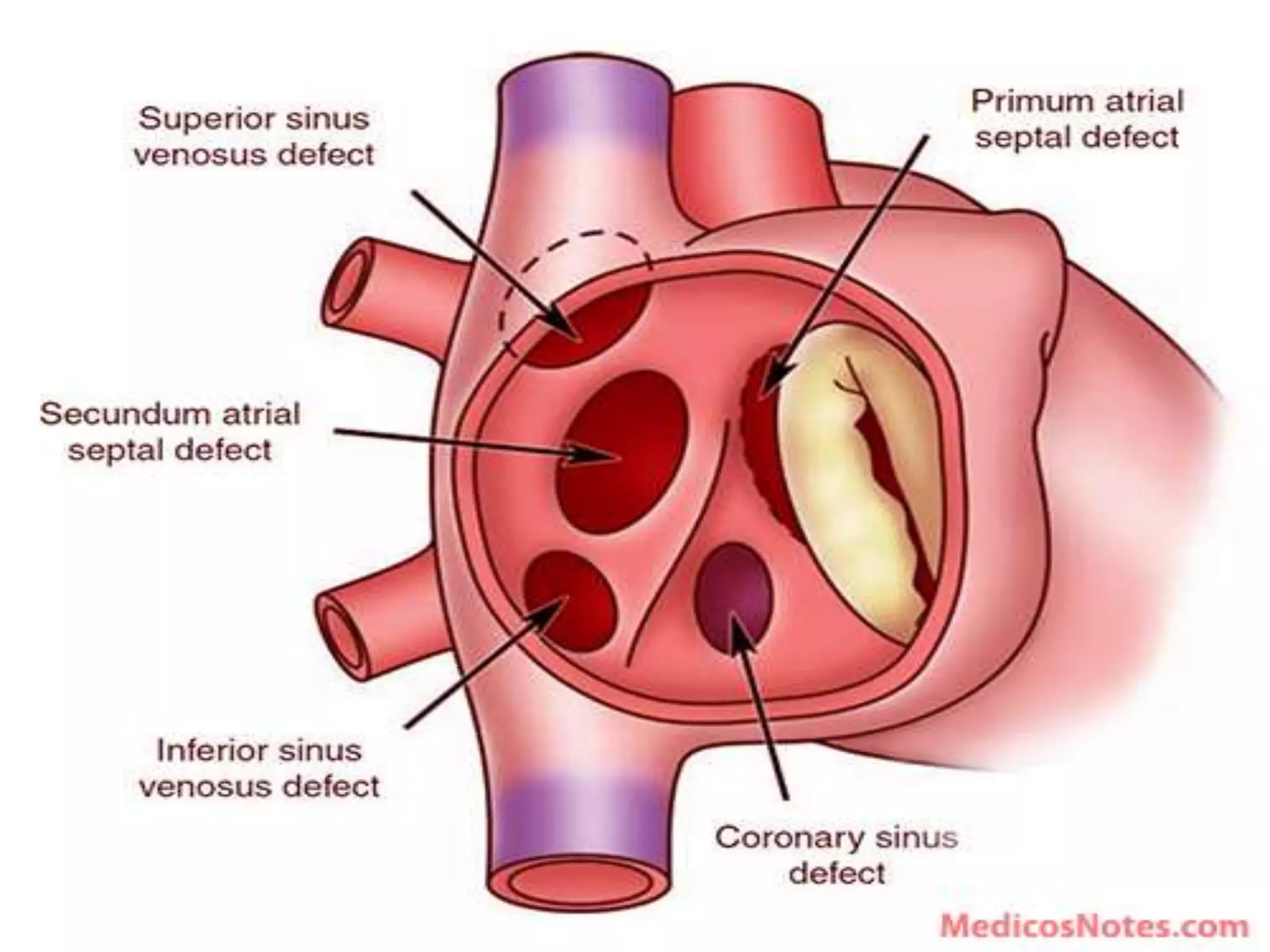 Interior of right atrium | PPTX
